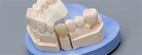 Dentures Mold Eagle Harbor Dentist