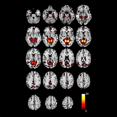 Retrosplenial Cingulate Cortex Areas 29 30 Radiology Key