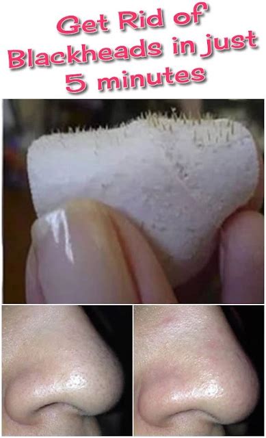 Get Rid Of Blackheads In Just 5 Minutes Health Craze