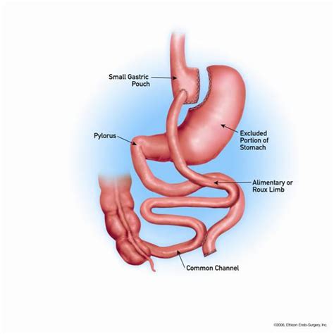 Laparoscopic Gastric Bypass Surgery University Surgeons Associates Pc