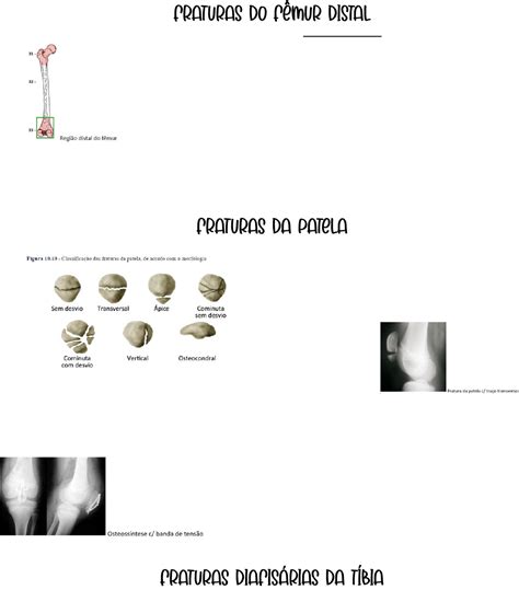 Fig Garden Classification System Of Femoral Neck Fractures A🤪