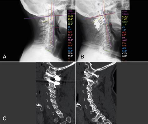 A Female Patient With Basilar Invagination With Preoperative