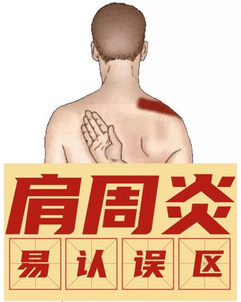 怎样判断是不是肩周炎，容易判断错误的几个症状？我用发生在申骨堂申一贴门店的小故事告诉你 知乎
