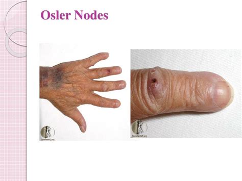 Ppt Infective Endocarditis Powerpoint Presentation Free Download Id 2253950