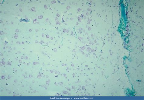 Focal Cortical Dysplasias MedLink Neurology