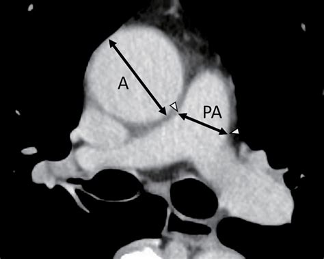 Lobectomy Increases Postoperative Pulmonary Artery Enlargement To A