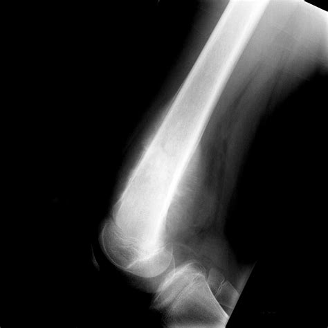 Osteogenic Sarcoma Sunburst