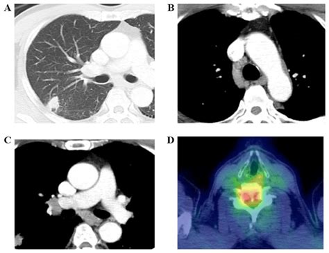 Chest Computed Tomography Ct On Admission Revealed A A Mass In The