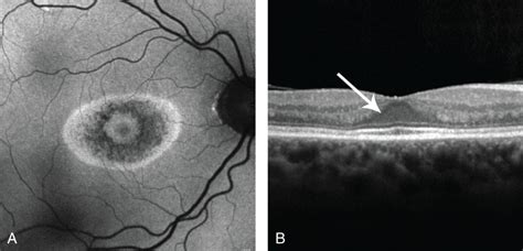Ocular Side Effects Of Systemic Medication Ento Key