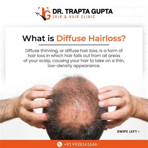 Understanding Hair Loss Causes Treatments And The Best Hair Loss