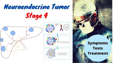 Neuroendocrine Tumor Stage 4 Symptoms Tests Treatment Youtube