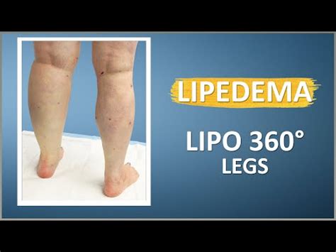 Lipedema Liposuction Surgery Treatment Art Lipo