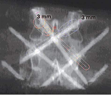 Figure 6 From Bone‐mounted Miniature Robotic Guidance For Pedicle Screw And Translaminar Facet
