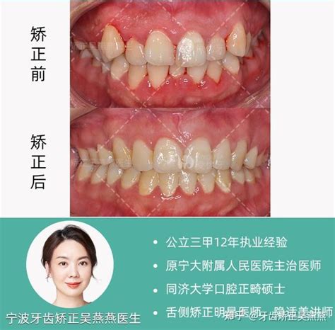 宁波牙齿矫正 隐适美正畸案例 知乎