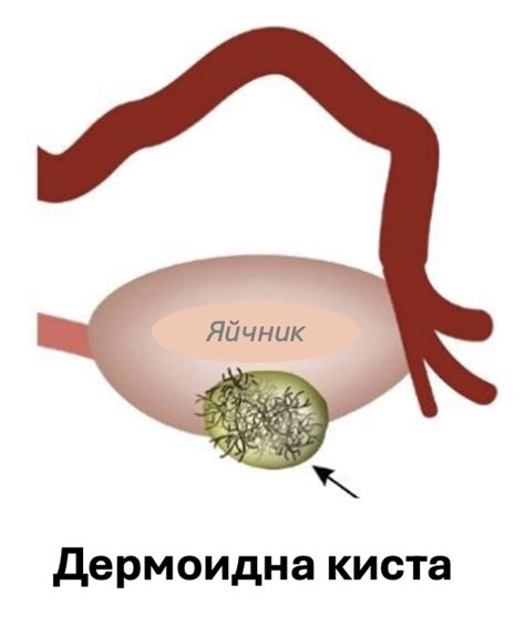 КИСТИ НА ЯЙЧНИКА ВИДОВЕ ПОЛИКИСТОЗНИ ЯЙЧНИЦИ д р А Налбански акушер гинеколог