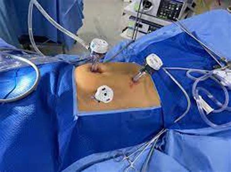 Laparoscopic Right Extended Colectomy Performed At Ankur Maitrika