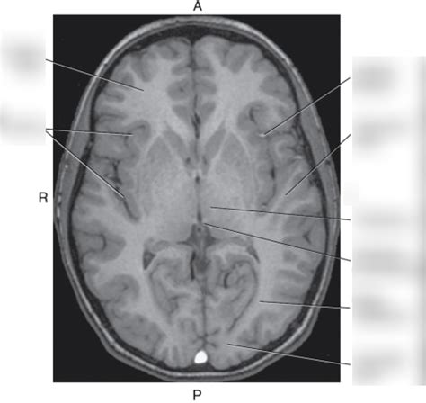 Axial Brain 2 Diagram Quizlet