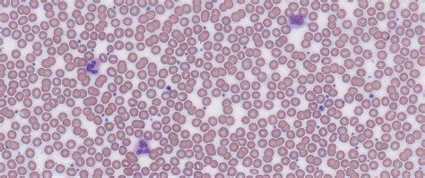 Diagnosis Of Anemia Leukemia Pathology