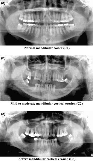 Panoramic Radiographs Demonstrating The Appearance Of Mandibular Cortex Download Scientific
