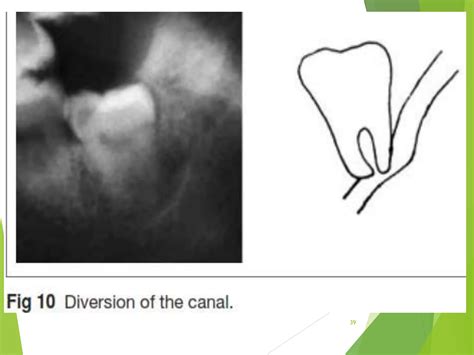 Third Molar Impacted Tooth Development And Surgical Complications Pptx