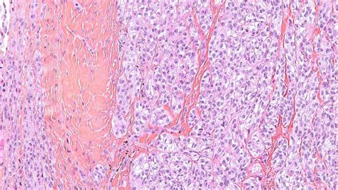 Cutting Edge Immunotherapy Wins Fda Approval In Rare Sarcomas