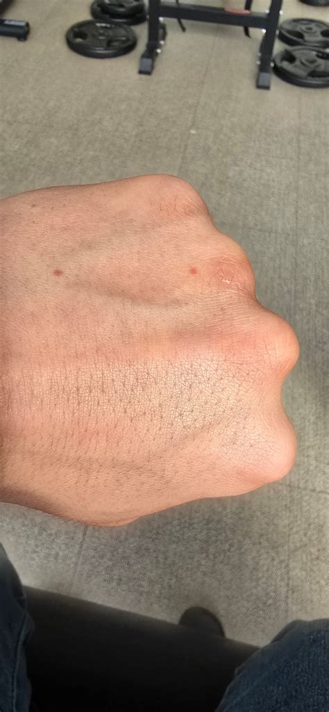 몸에 붉은 반점이 한개씩 생깁니다 지식in