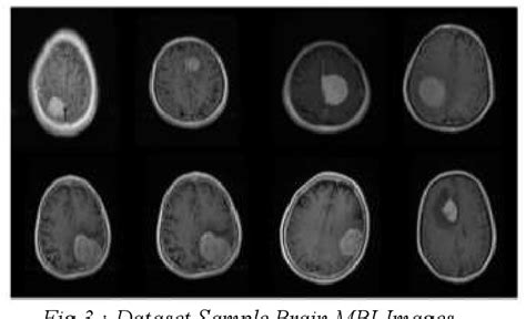 Figure 3 From Image Segmentation Using Mask R CNN For Tumor Detection