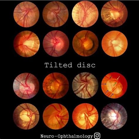 Rao Musaddaq Ali On Linkedin Congenital Tilted Disc Syndrome The Tilted Disc Syndrome Presents