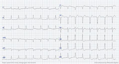 Dr Smiths Ecg Blog Baseline Wander But What Else Do You See