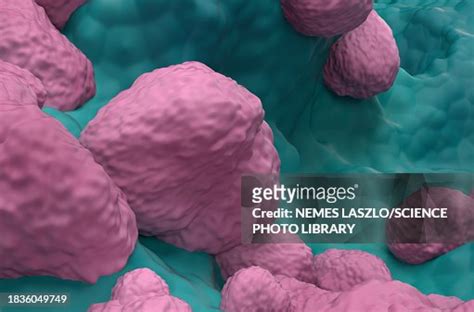 Nonsmall Cell Lung Cancer Illustration High Res Vector Graphic Getty