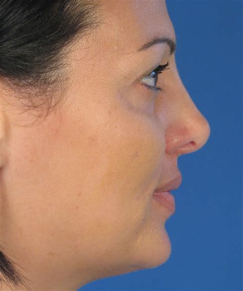 Case Example Of Hanging Columella Revision Rhinoplasty San Diego Ca