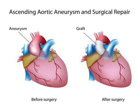 Aortic Root Reconstruction Heartplace Cardiovascular Disease