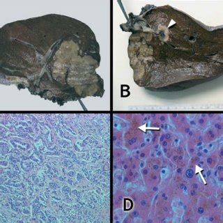 PDF Hepatectomía derecha extendida por colangiocarcinoma intrahepático en un paciente con