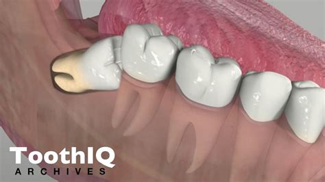 Cuspid Teeth Removal At Santos Long Blog