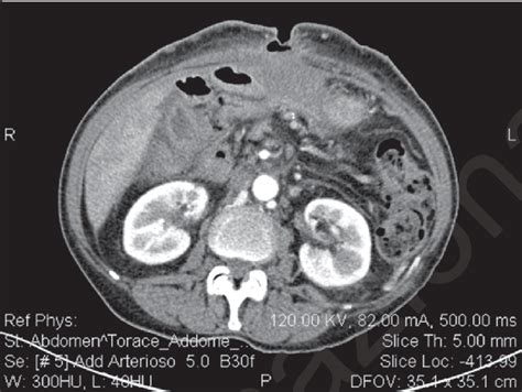 Ct Scan Umbilical Fluid Collection Download Scientific Diagram