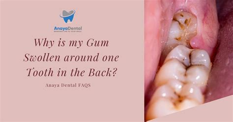 Why Is My Gum Swollen Around One Tooth In The Back Anaya Dental