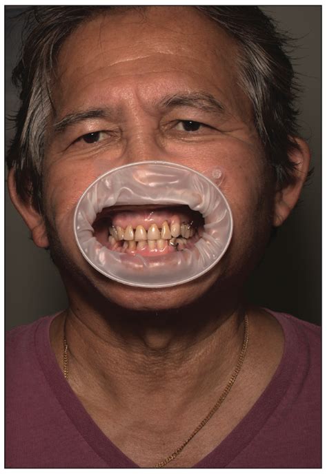 A Simplified Fully Digital Workflow For Full Arch Provisional Restorations On305