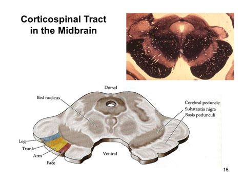 Spinothalamic Tract Midbrain