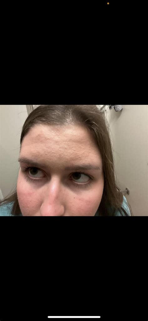 2 Weeks Post Accutane Tiny Bumps All Over Face Rfungalacne