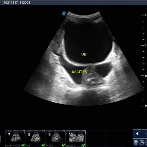 Dilated Common Bile Duct Cbd And Pancreatic Duct Pd And Linear