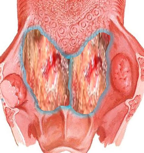 Transoral Robotic Partial Glossectomy And Supraglottoplasty For