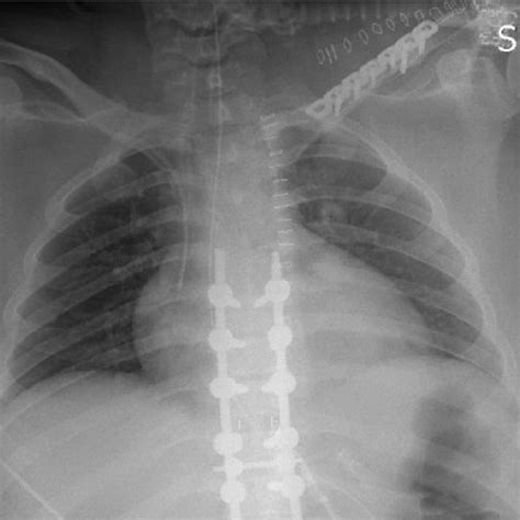 X Ray Of Post Operative Plating Of The Left Clavicle Download Scientific Diagram