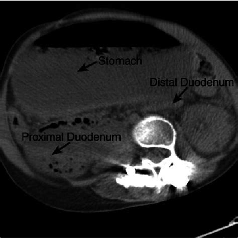 An Axial Image Of A Computed Tomography Ct Of Abdomen And Pelvis
