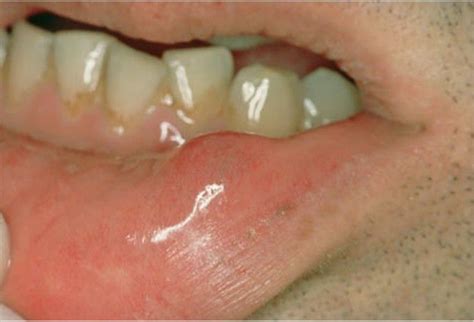 Mucocele Medizzy