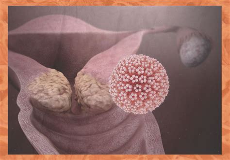 Síntomas Del Cáncer Cervicouterino Archivos Mala Espina