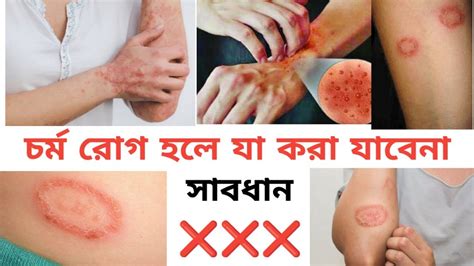 চর্ম রোগ দাউদ একজিমা বিখাউজ হলে যা কখনো করবেন না সাবধান ৷ এই কথা কেউ