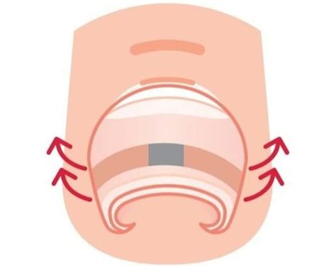 Nail Bracing Surgery Is Not Ingrown Toenail Clinic
