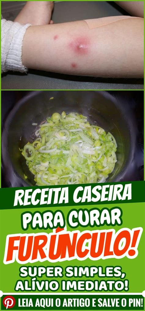 Receita caseira para você ajudar no tratamento de furúnculo Receitas Comida caseira Receita