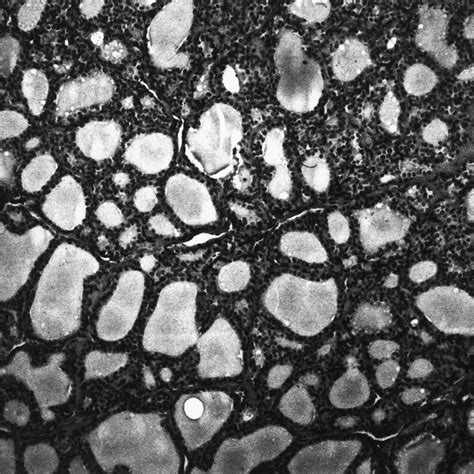 Histology Of The Resected Thyroid Gland Showing Diffuse Hyperplasia And Download Scientific
