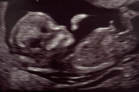 Gender Prediction Help Mumsnet